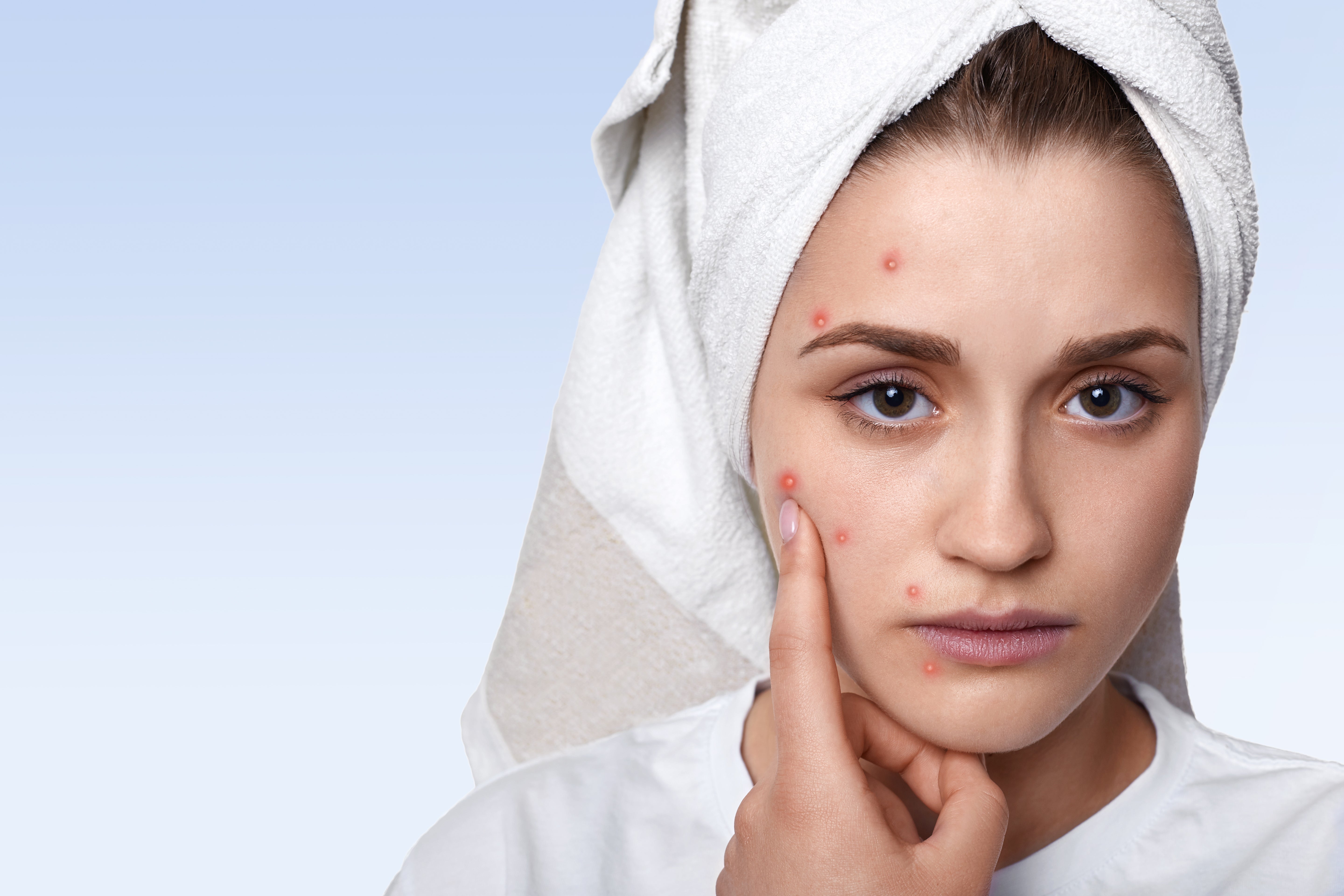 Causes of Acne & How to Prevent It Naturally (A Complete Guide) – Lashika Skincare
